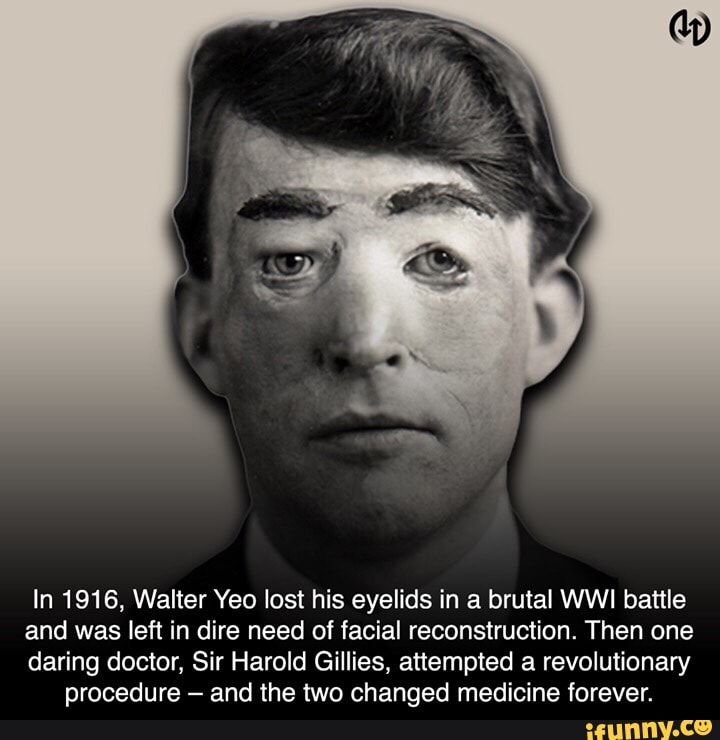 In 1916, Walter Yeo lost his eyelids in a brutal WWI battle and was ...