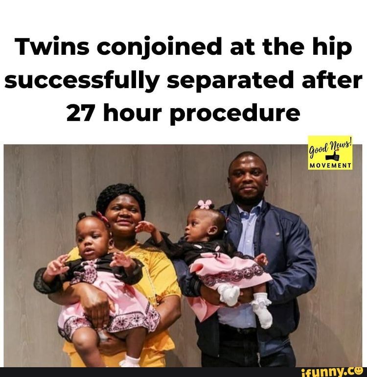 Twins conjoined at the hip successfully separated after 27 hour ...