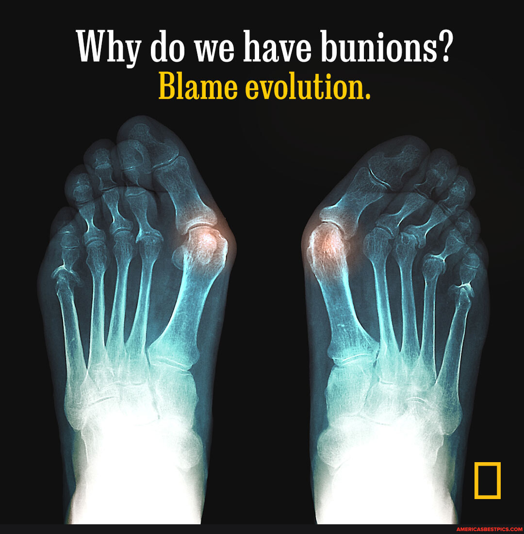 Bunions have plagued human toes since ancient times. The foot deformity ...