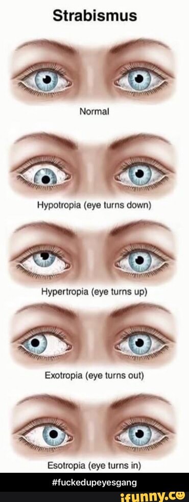 Strabismus memes. Best Collection of funny Strabismus pictures on iFunny