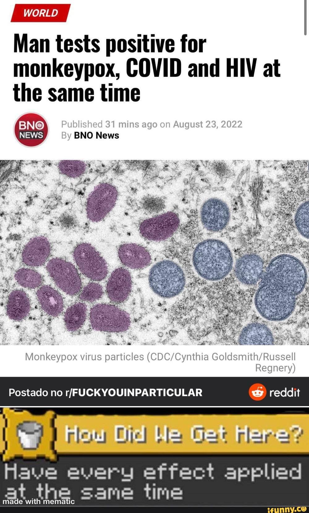 WORLD Man tests positive for monkeypox, COVID and HIV at the same time ...