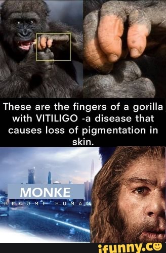 These are the fingers of a gorilla with VITILIGO -a disease that causes ...