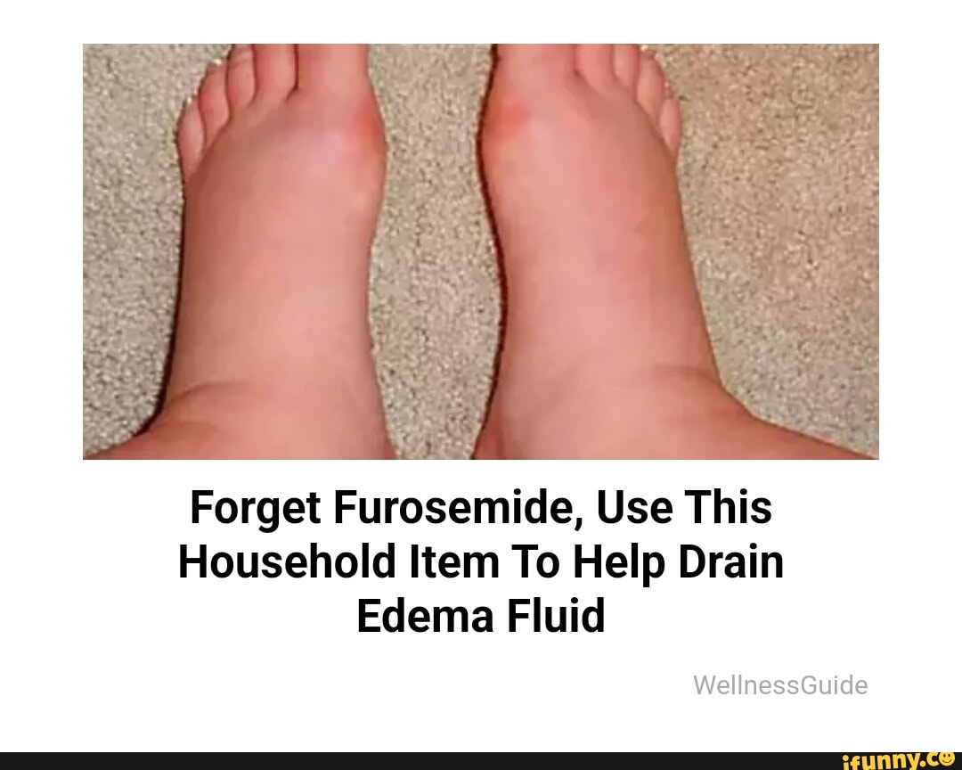 Edema memes. Best Collection of funny Edema pictures on iFunny