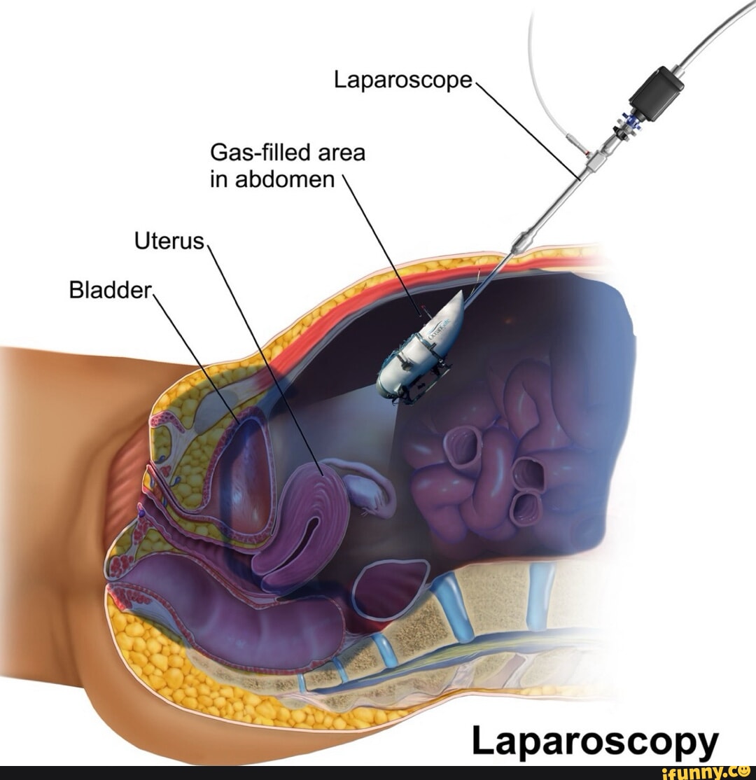 Gas-filled area in abdomen Laparoscopy - iFunny