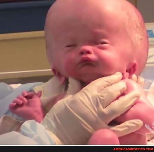 Parker was born with hydrocephalus, an abnormal buildup of fluid in the ...