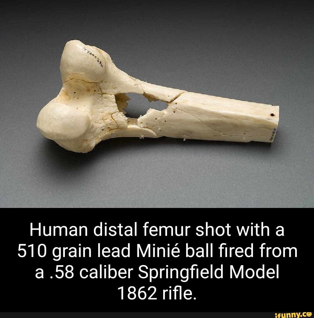 Human distal femur shot with a 510 grain lead Mini ball fired from a ...