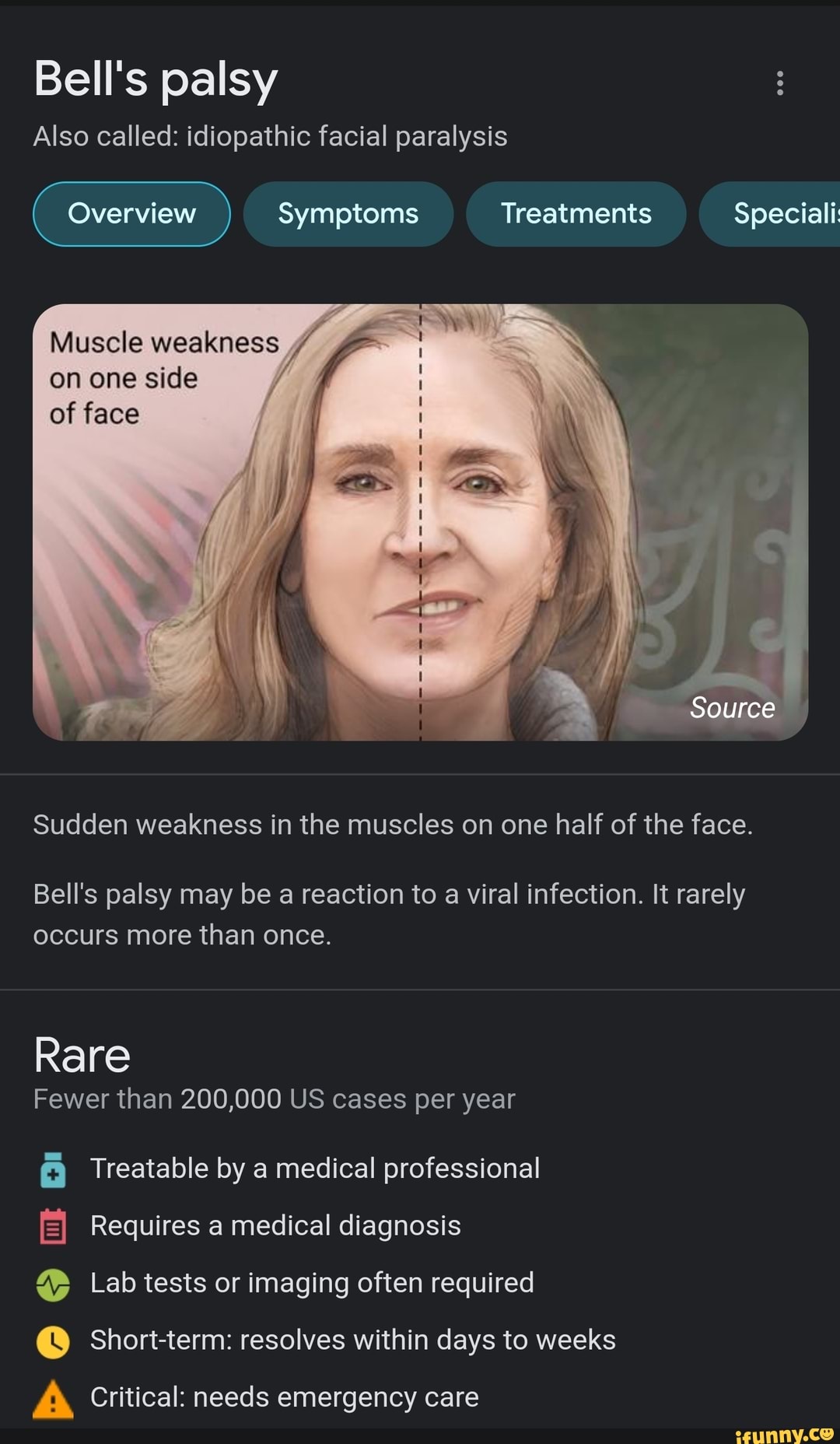 Bell's palsy Also called: idiopathic facial paralysis Overview Symptoms ...