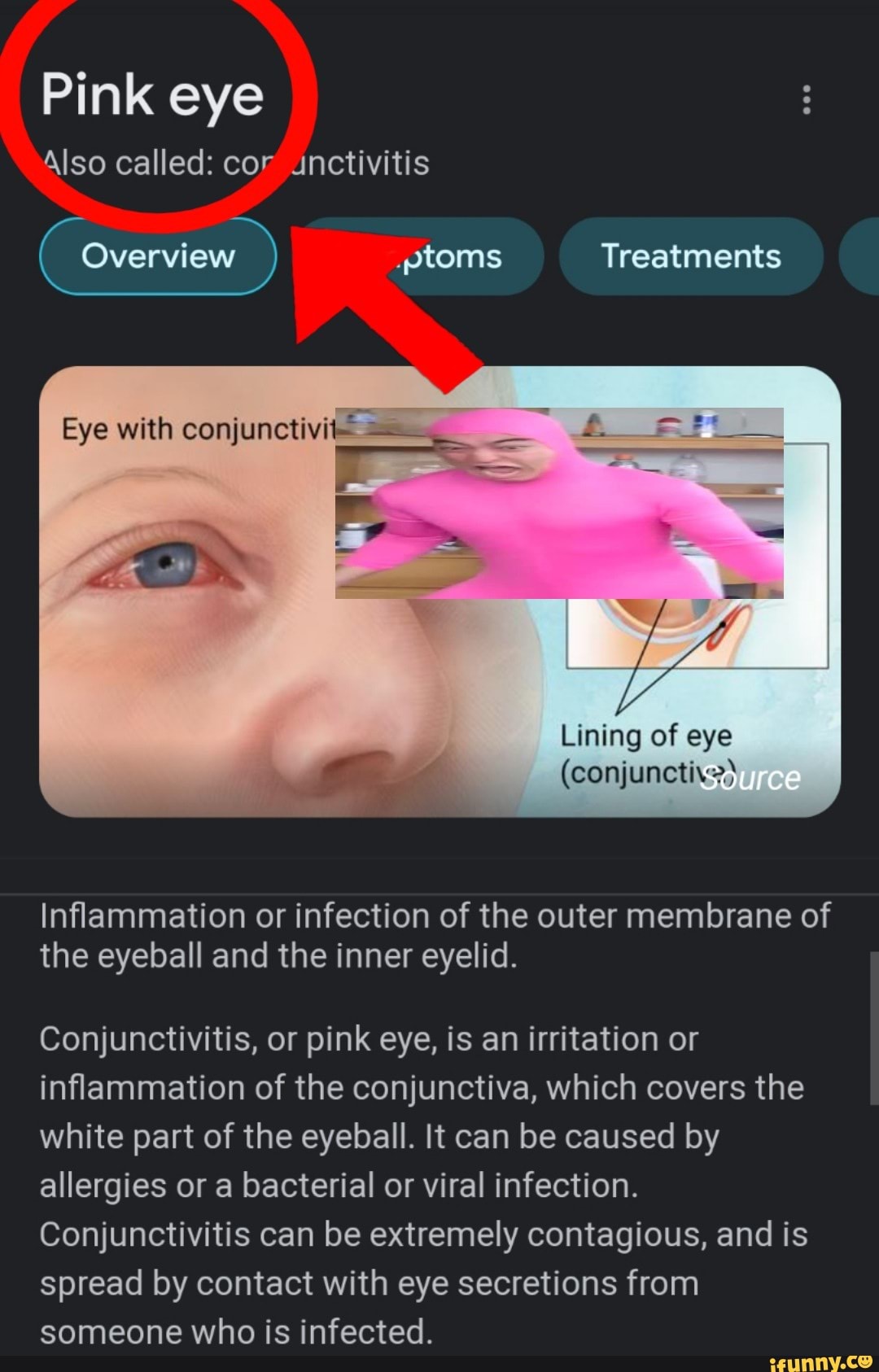 Conjunctivitis memes. Best Collection of funny Conjunctivitis pictures ...