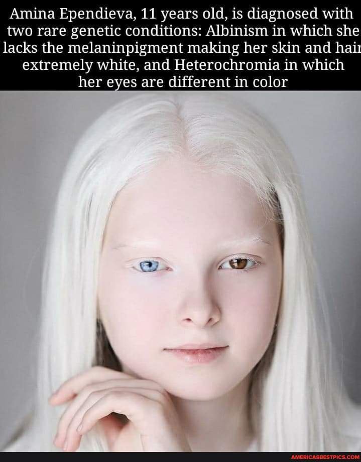 Amina Ependieva, 11 years old, is diagnosed with two rare genetic ...