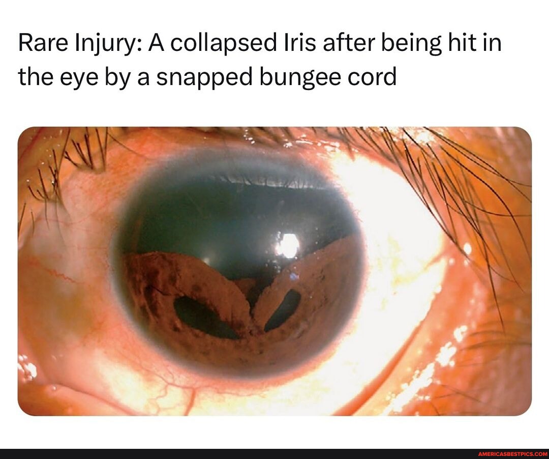 But can you still see memes explore science photography - Rare Injury ...