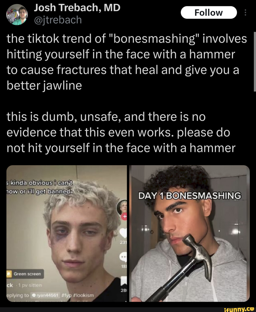Bonesmashing rule - Josh Trebach, MD @jtrebach Follow the tiktok trend ...