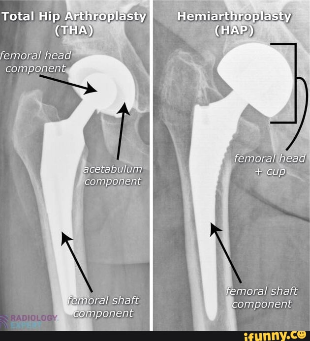 Total Hip femoral head component CHAP) cetabulum component femoral ...
