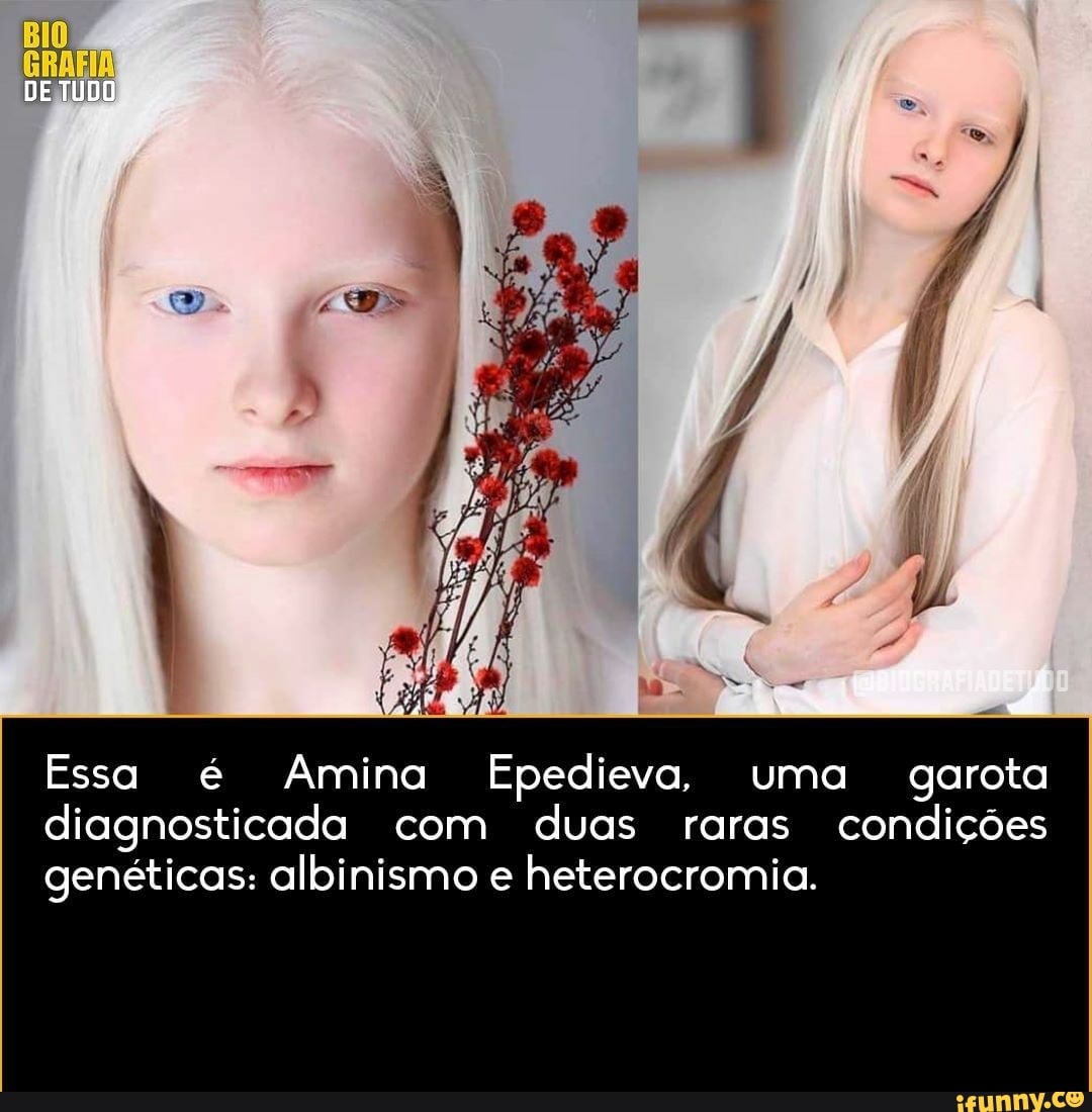 Albinismo memes. Best Collection of funny Albinismo pictures on iFunny ...