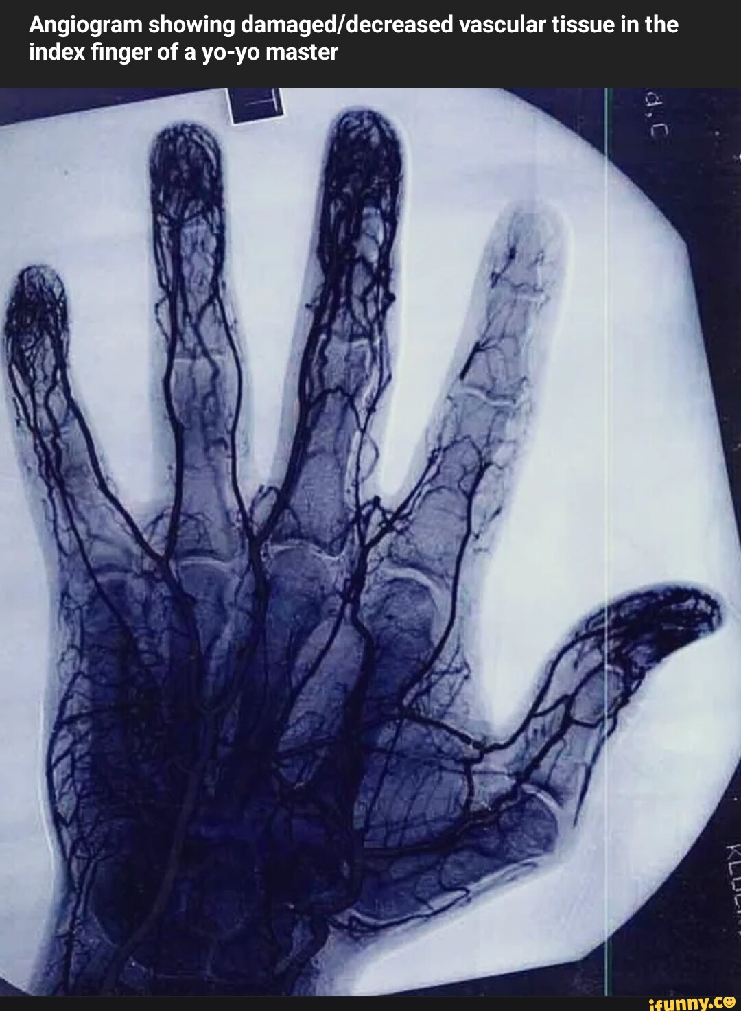 Angiogram showing vascular tissue in the index finger of a yo-yo master ...