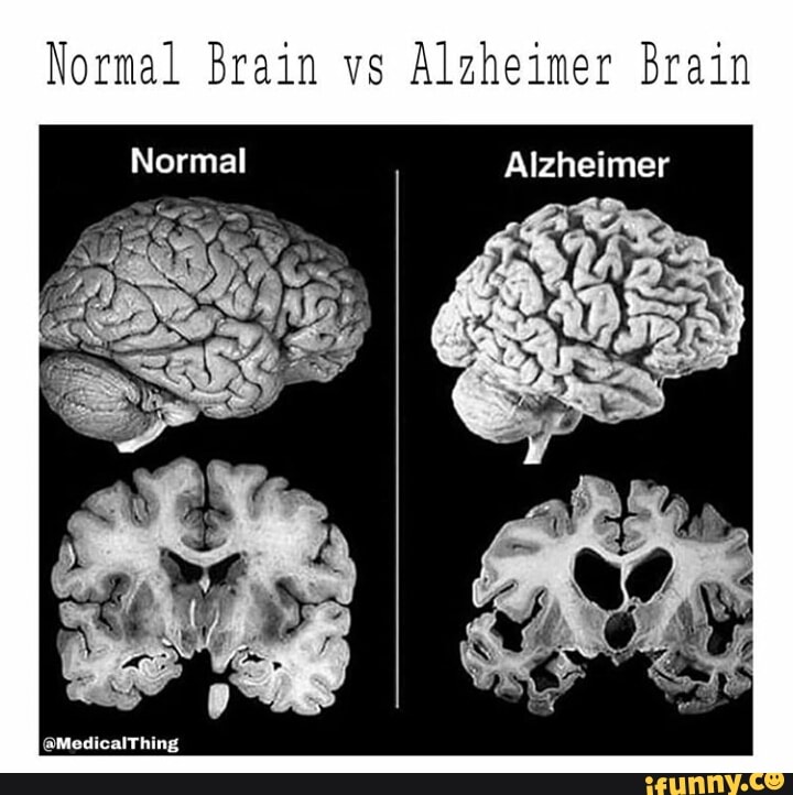 Normal Brain vs Alzheimer Brain - iFunny