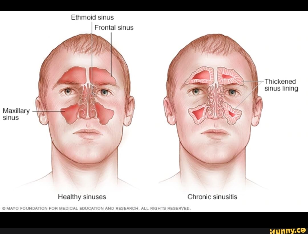 Sinusitis memes. Best Collection of funny Sinusitis pictures on iFunny