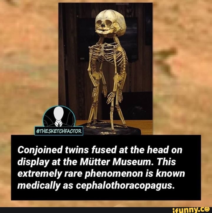 Conjoined twins fused at the head on display at the Miitter Museum ...