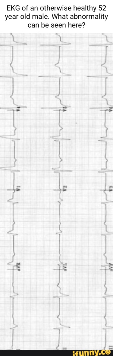 EKG memes. Best Collection of funny EKG pictures on iFunny