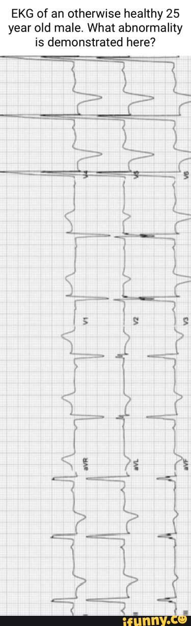 Ekg memes. Best Collection of funny Ekg pictures on iFunny