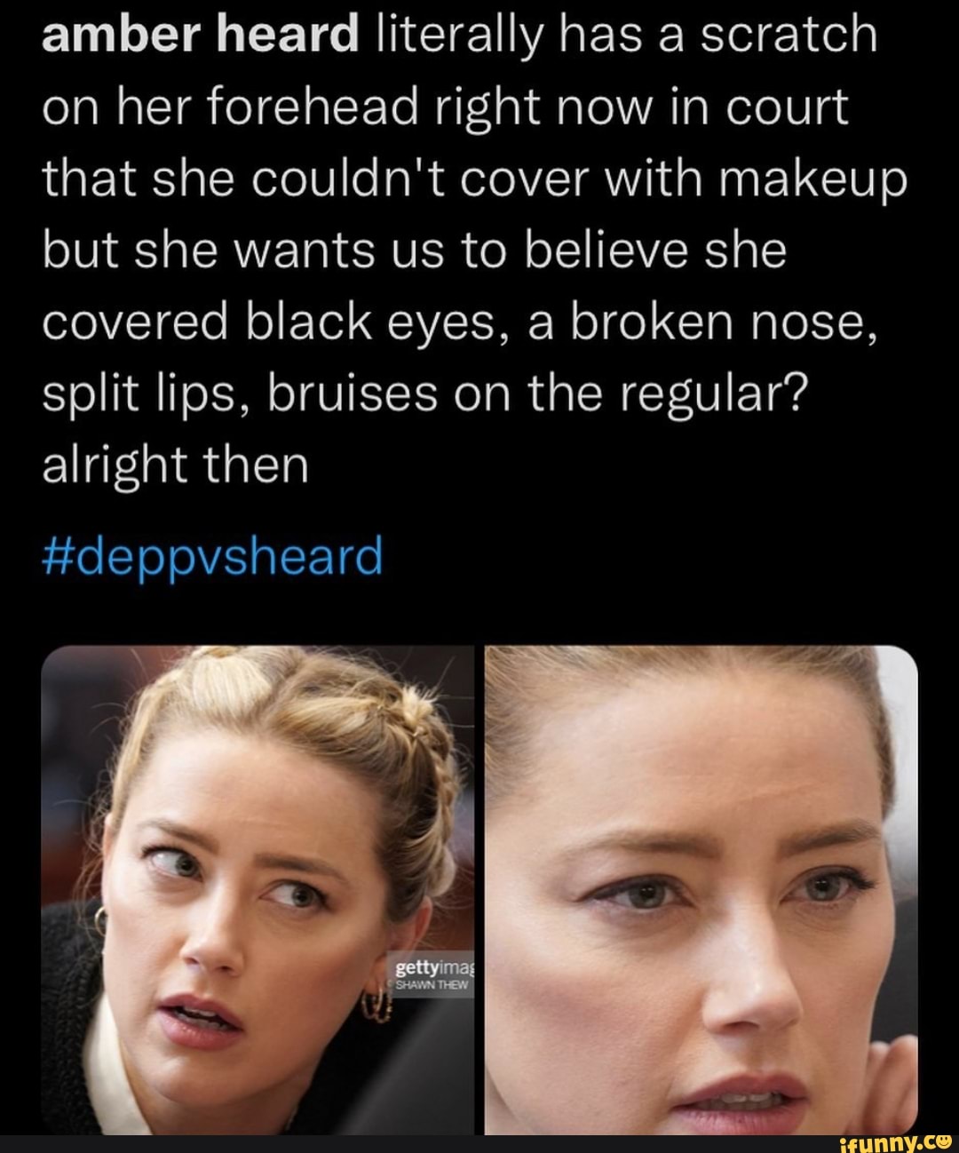 Amber heard literally has a scratch on her forehead right now in court ...