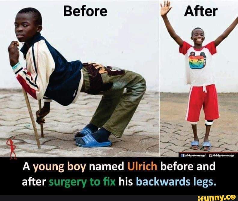 Before After A young boy named Ulrich before and after surgery to fix ...