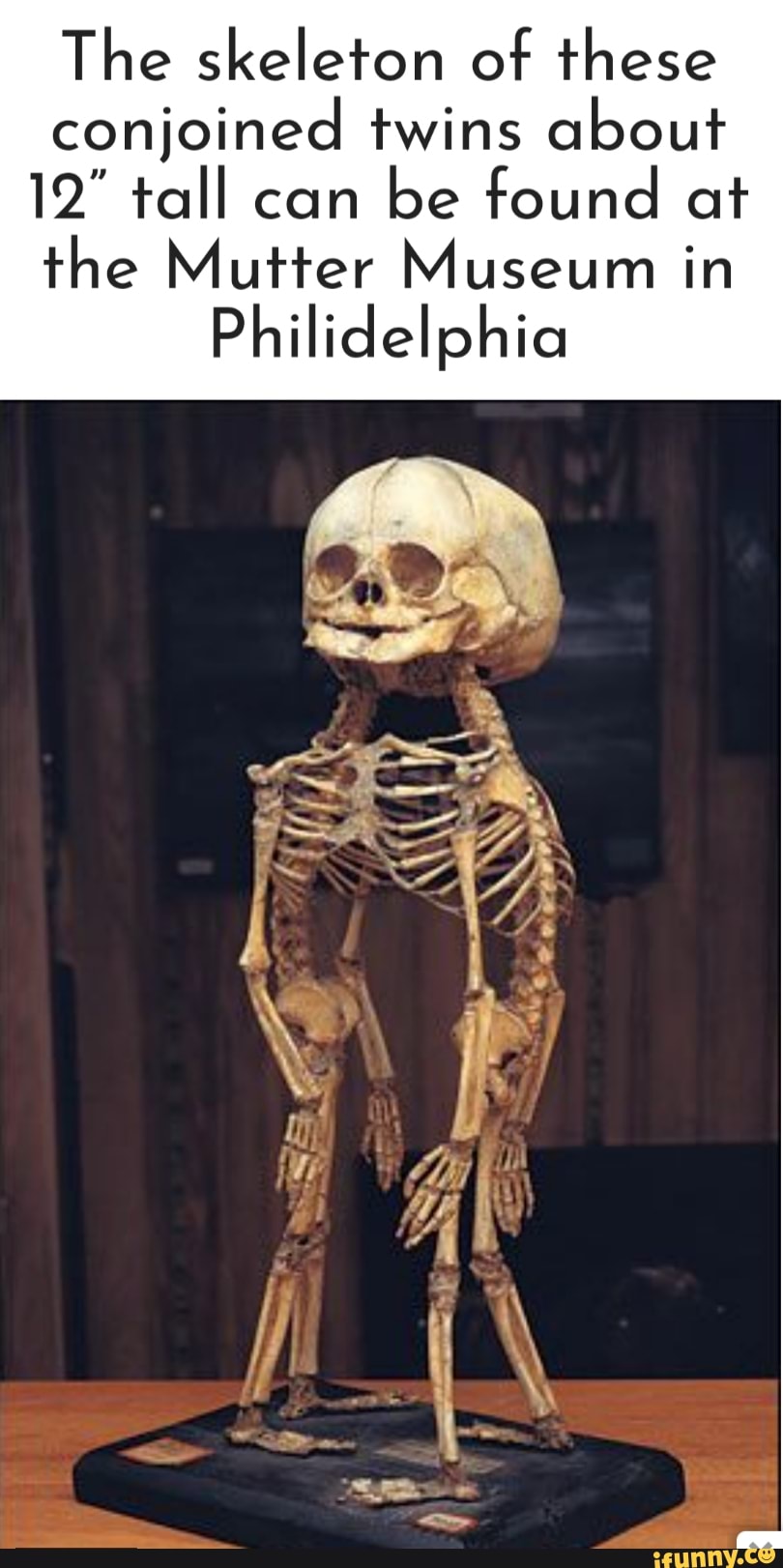The skeleton of these conjoined twins about 12" tall can be found at ...
