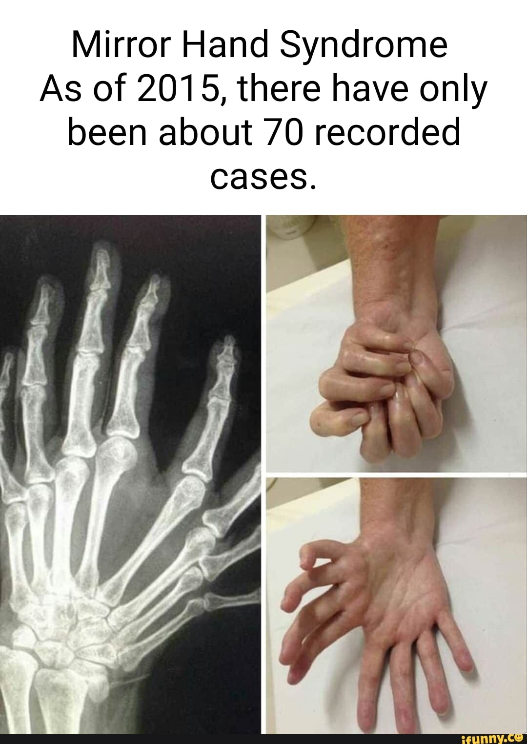 Mirror Hand Syndrome As of 2015, there have only been about 70 recorded ...