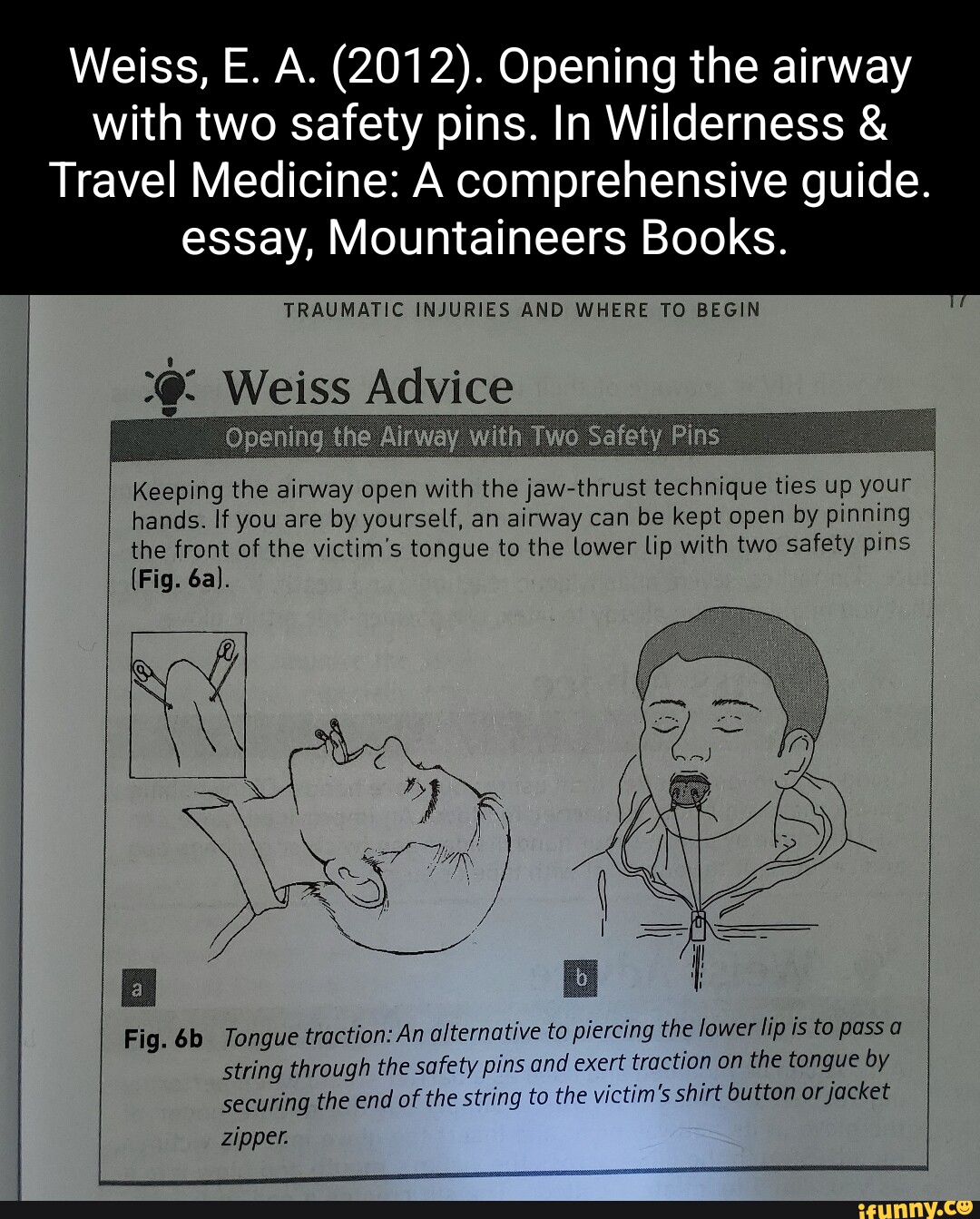 Weiss, E. A. (2012). Opening the airway with two safety pins. In ...