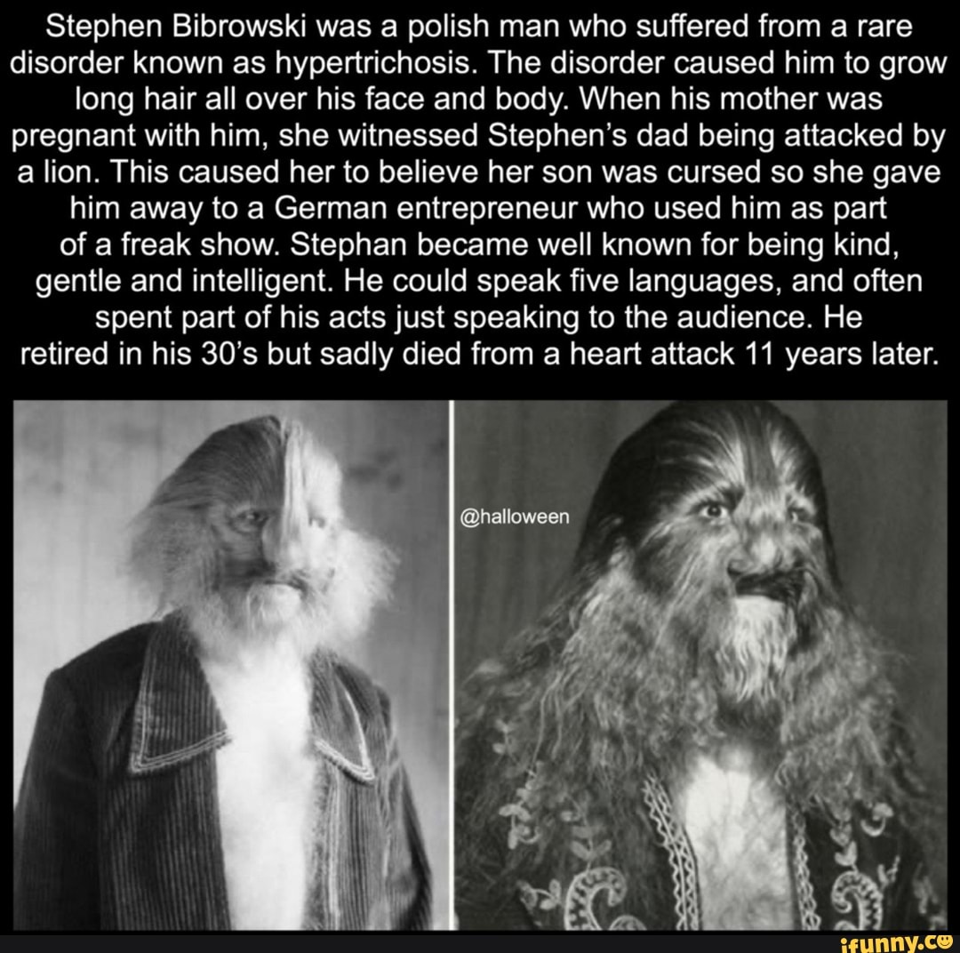 Stephen Bibrowski was a polish man who suffered from a rare disorder ...