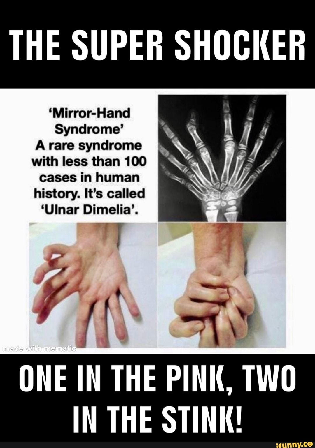 THE SUPER SHOCKER 'Mirror-Hand Syndrome' A rare syndrome with less than ...