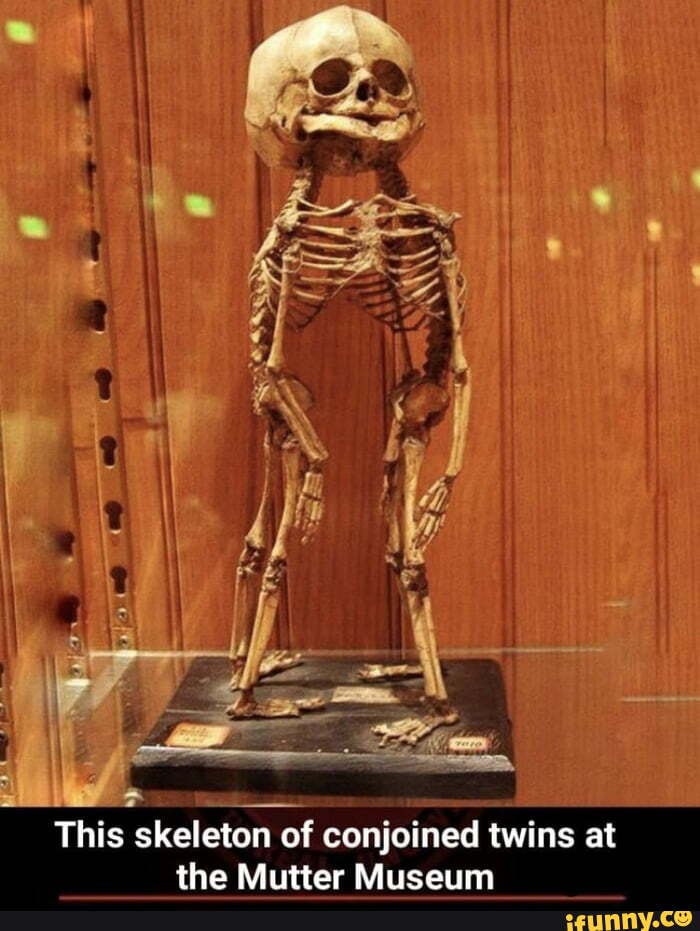 This skeleton of conjoined twins at the Mutter Museum - iFunny