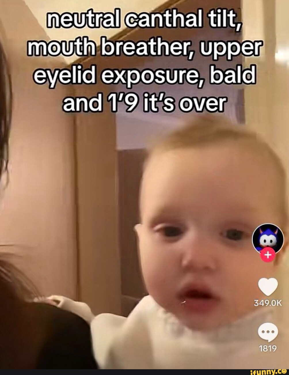 Neutral canthal tilt, mouth breather, upper evelid exposure, bald and ...