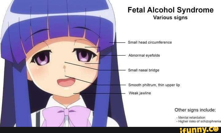 Fetal Alcohol Syndrome Various signs 'Small head circumference ...