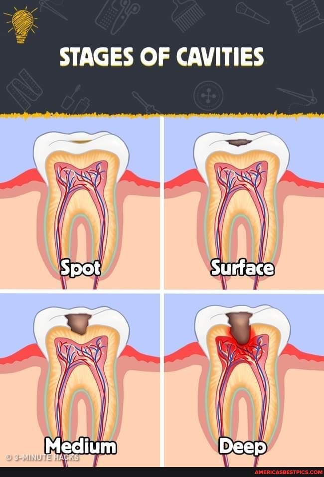 STAGES OF CAVITIES Medium Deep - America’s best pics and videos