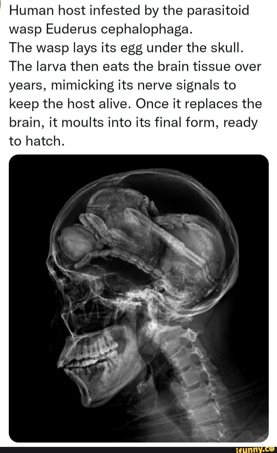 Human Host Infested By The Parasitoid Wasp Euderus Cephalophaga The Wasp Lays Its Egg Under The human-host-infested-by-the-parasitoid-wasp-euderus-cephalophaga-the-wasp-lays-its-egg-under-the