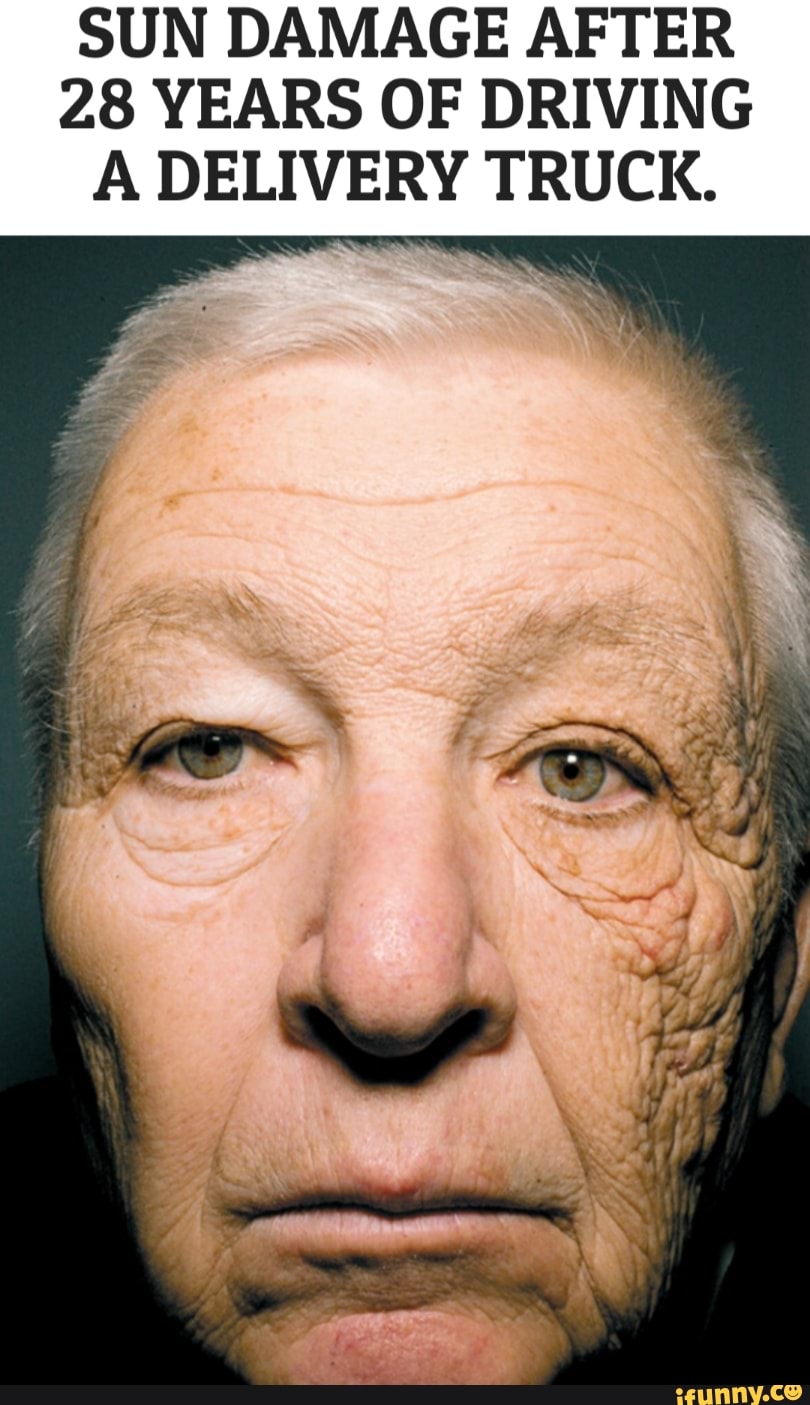 SUN DAMAGE AFTER 28 YEARS OF DRIVING A DELIVERY TRUCK. - iFunny