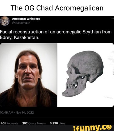 The OG Chad Acromegalic Facial reconstruction of an acromegalic ...