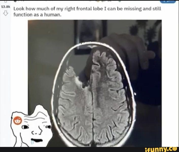 23.0k Look how much of my right frontal lobe I can be missing and still ...