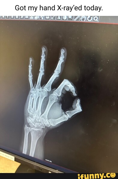 Got my hand X-ray'ed today. - iFunny