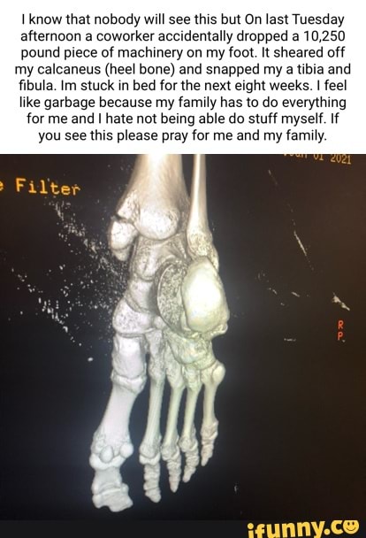 Calcaneus memes. Best Collection of funny Calcaneus pictures on iFunny