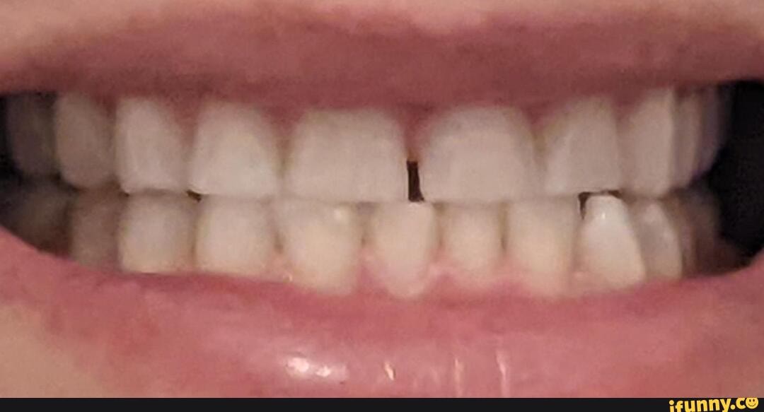 Invisalign memes. Best Collection of funny Invisalign pictures on iFunny