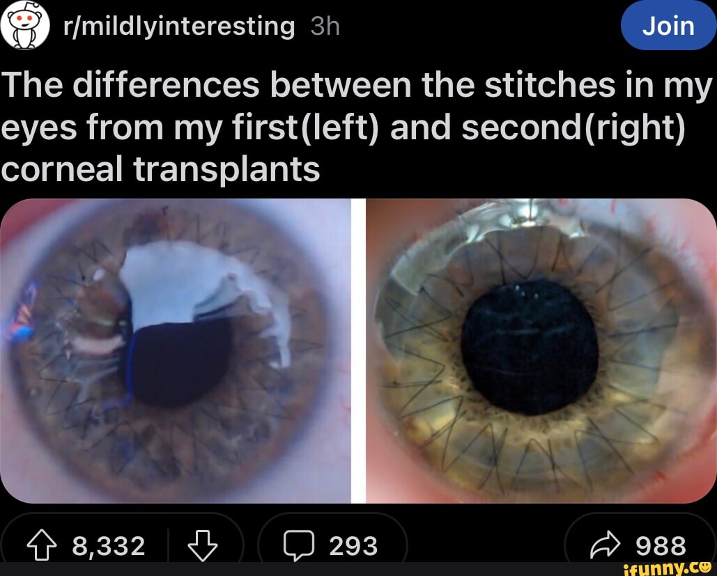 Join The differences between the stitches in my eyes from my and second ...