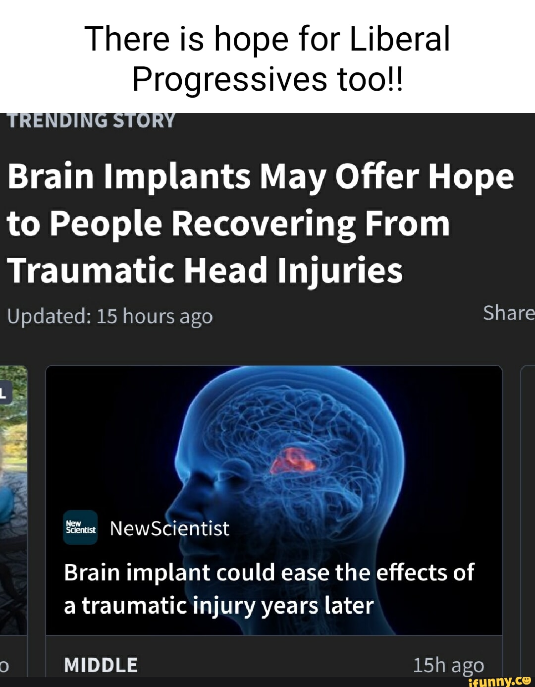 Implants memes. Best Collection of funny Implants pictures on iFunny