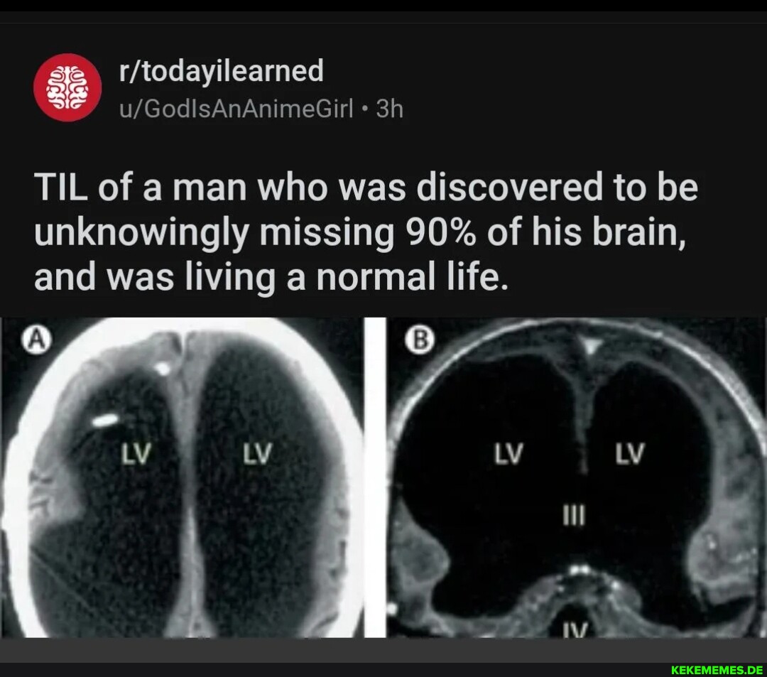 TIL of a man who was discovered to be unknowingly missing 90% of his ...
