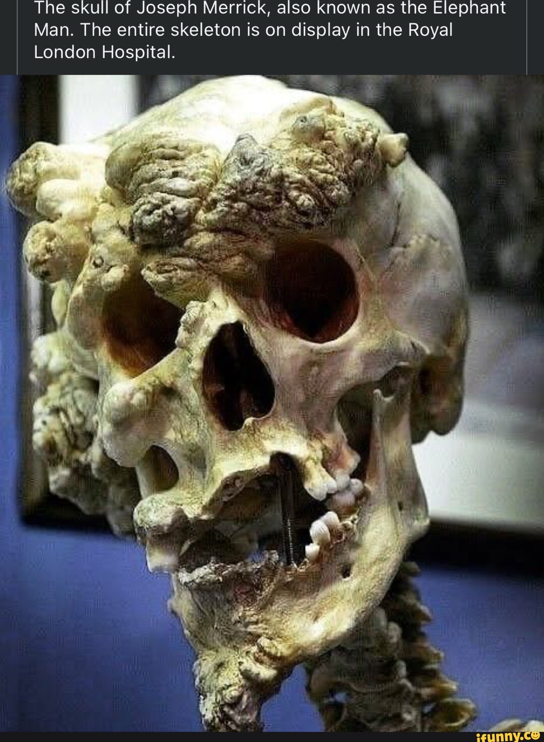 The skull of Joseph Merrick, also Known as the Elephant Man. The entire ...