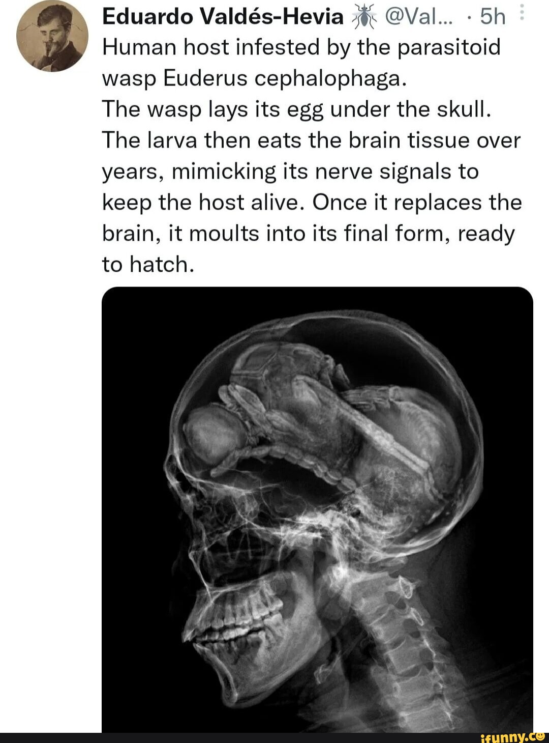 Eduardo Valdes-Hevia @Val... SA Human host infested by the parasitoid ...