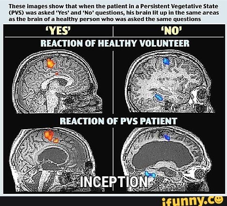 These images show that when the patient in a Persistent Vegetative ...