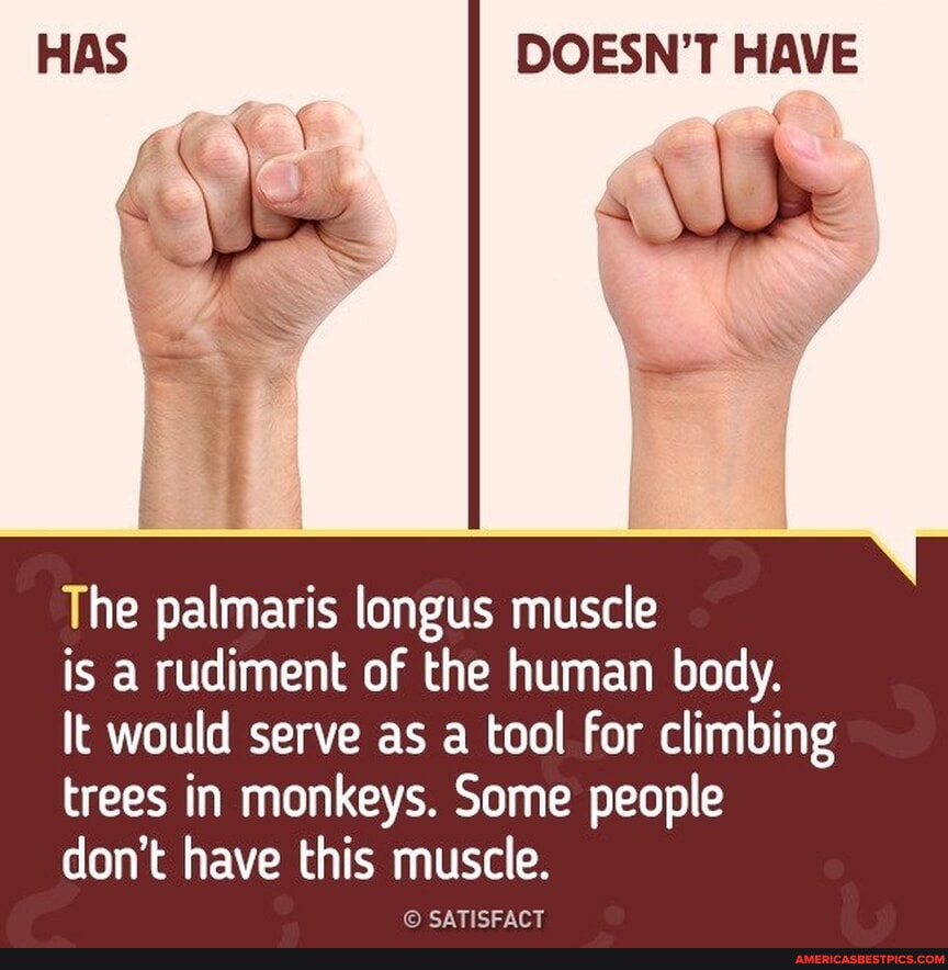 Palmaris Longus: The Muscle You Might Not Have – NWHECO