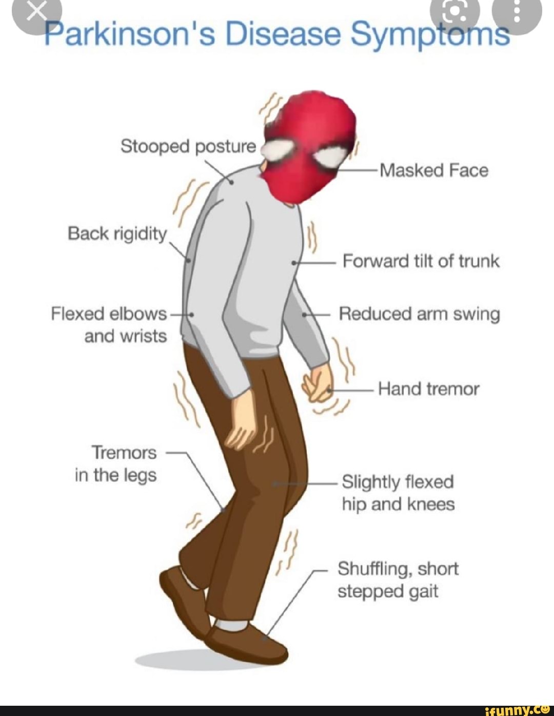 Parkinson's Disease Symp Stooped posture Masked Face Back rigidity ...