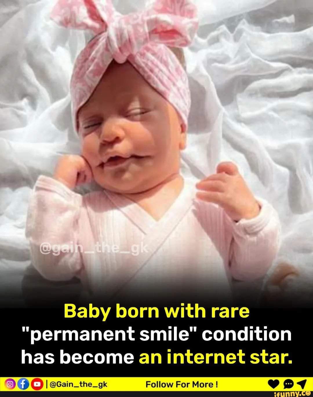 Baby born with rare "permanent smile" condition has become an internet ...